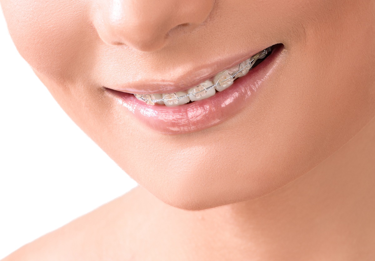 Why Patients Prefer Six Month Smiles Over Braces | Dr. Bell