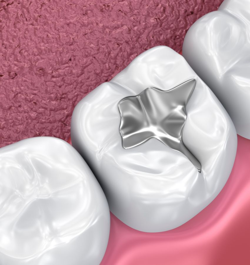Expert Fillings in Hallam and East York, PA