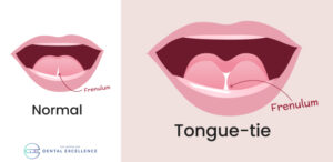 Long Term Risks Of Untreated Lip Tongue Ties Cdepa